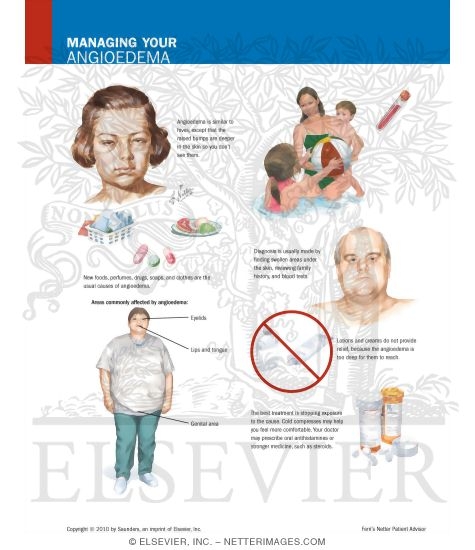 Managing Your Angioedema