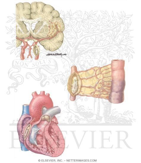 Thrombotic Disorders: Complications of Arterial Thrombosis