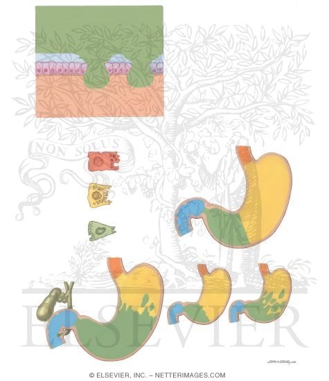 Mechanisms of Ulcer Formation
