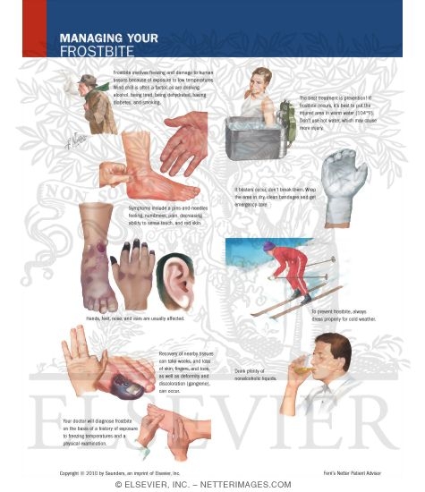 Managing Your Frostbite