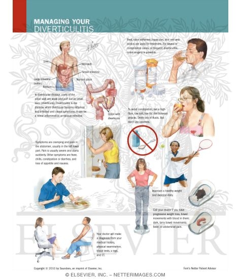 Managing Your Diverticulitis