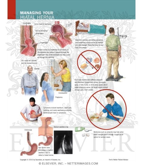 Managing Your Hiatal Hernia