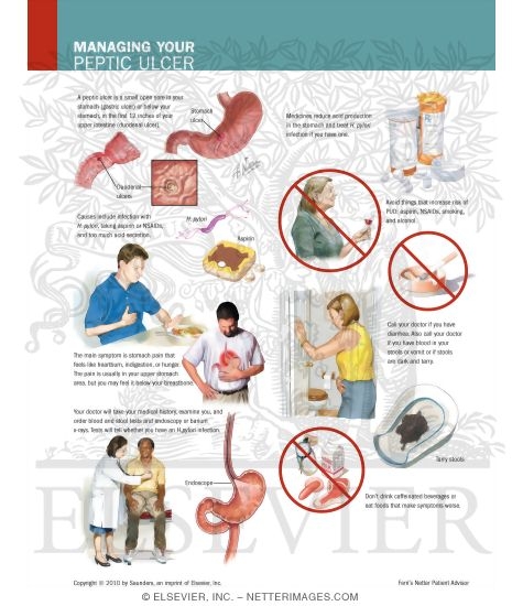Managing Your Peptic Ulcer