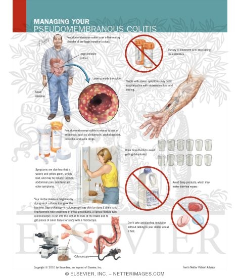 Managing Your Pseudomembranous Colitis