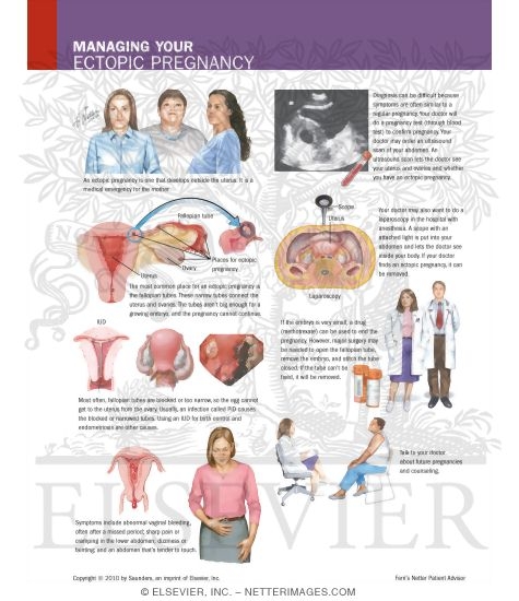 ectopic pregnancy leaflet