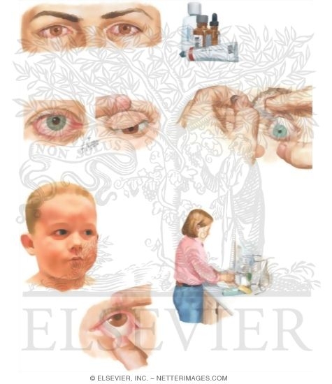 Managing Your Conjunctivitis