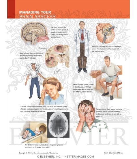 Managing Your Brain Abscess