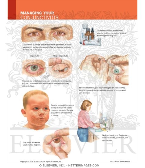 Managing Your Conjunctivitis