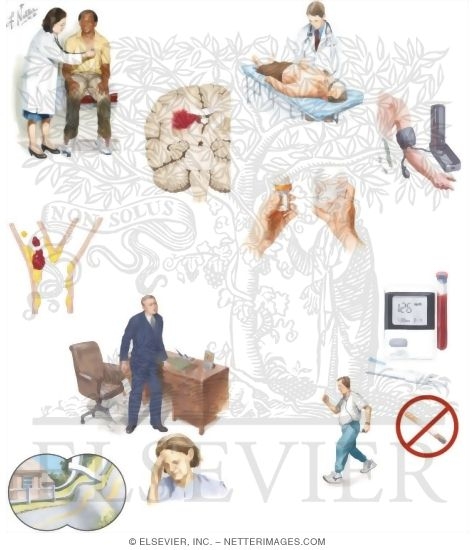 Managing Your Stroke