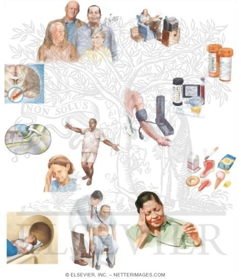 Managing Your Transient Ischemic Attack