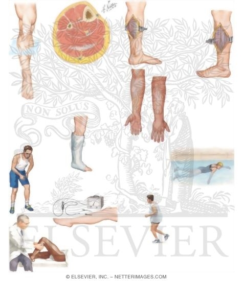 Managing Your Compartment Syndrome