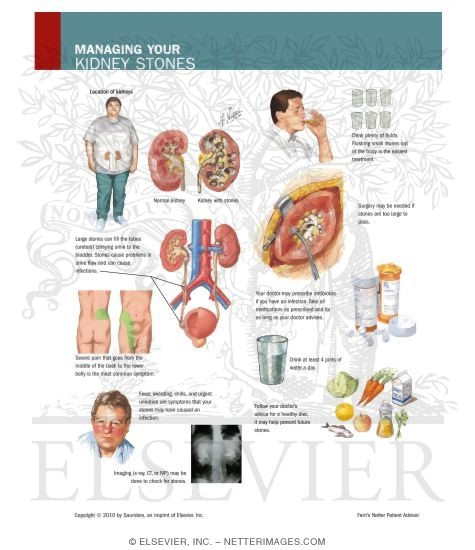 Managing Your Kidney Stones