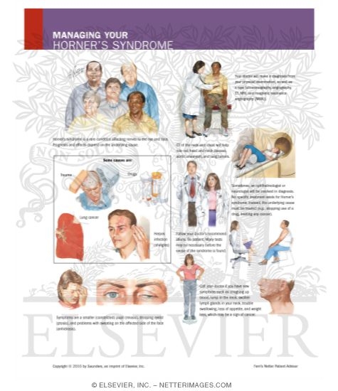 Managing Your Horner's Syndrome