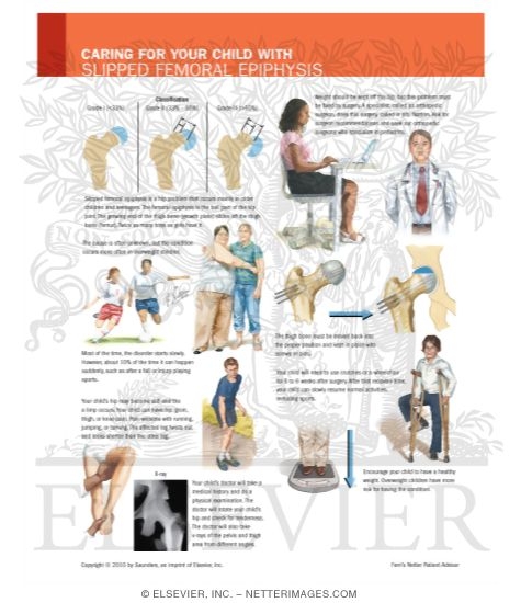 Caring for Your Child With Slipped Femoral Epiphysis