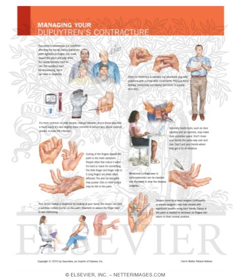 Managing Your Dupuytren's Contracture