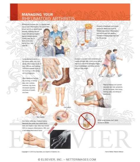 Managing Your Rheumatoid Arthritis