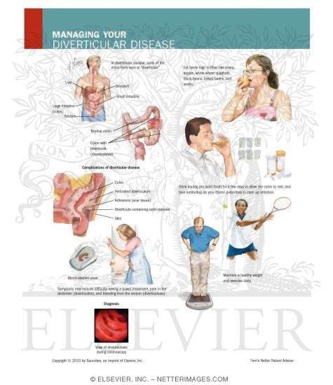 Managing Your Diverticular Disease