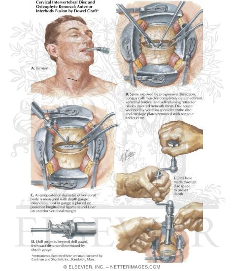 cervical osteophyte bar