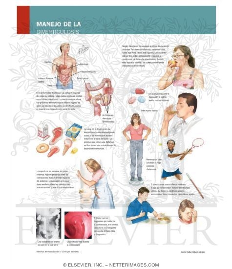 Managing Your Diverticulosis