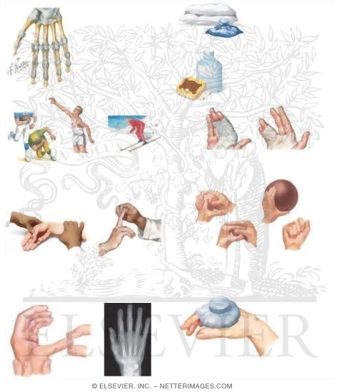 Managing Your Finger Sprain