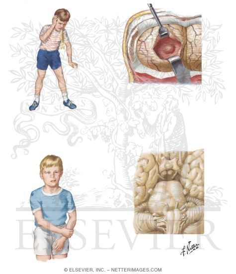 Brain Tumors In Children