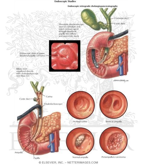 Gallstones: Endoscopic Studies, (Xray Plus Interior of Intestine)