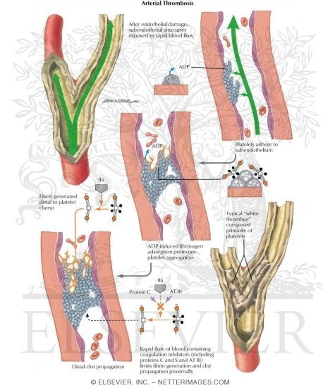 Thrombotic Disorders: Arterial Thrombosis