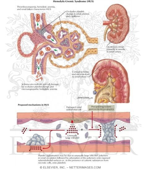 Hemolytic Uremic Syndrome