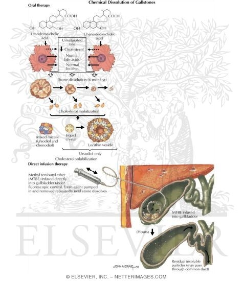 Chemical Dissolution of Gallstones