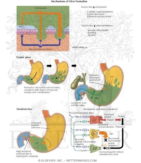 Mechanisms of Ulcer Formation