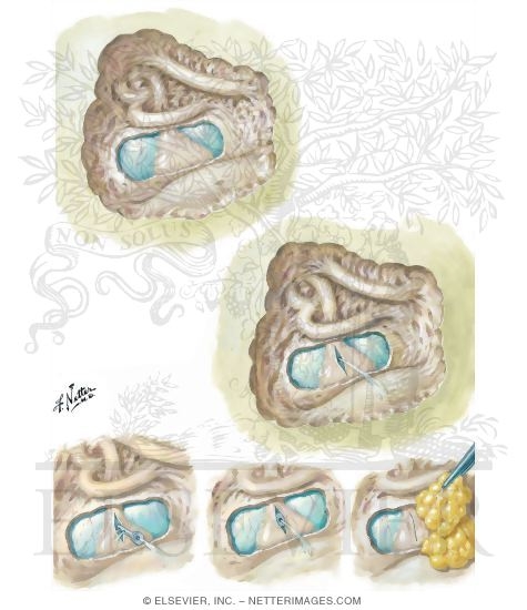 Endolymphatic: Subarachnoid Shunt for Meniere's Disease