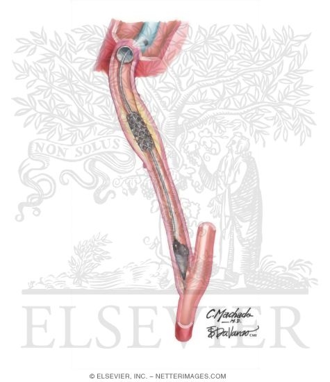 Distal Protection Device: Coronary Filter