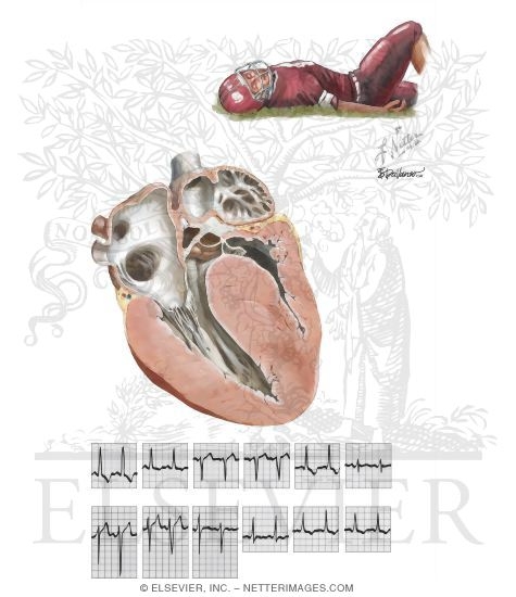 Sudden Death In Hypertrophic Cardiomyopathy
