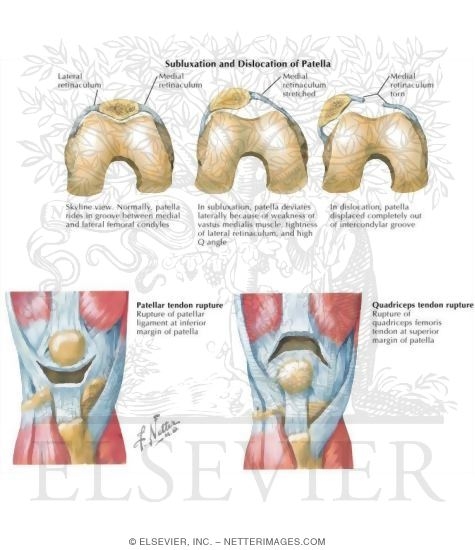 Disorders of the Leg and Knee Subluxation and Dislocation of Patella