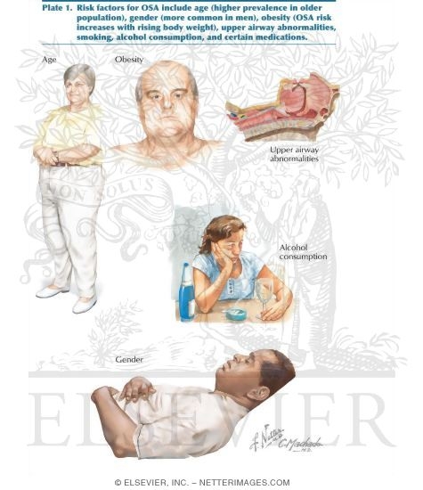 Risk Factors for Sleep Apnea