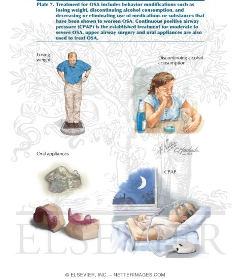 Treatment for Obstructive Sleep Apnea