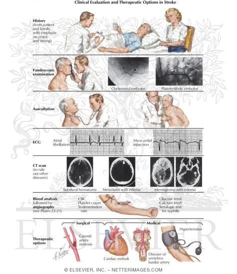 Clinical Evaluation and Therapeutic Options in Stroke