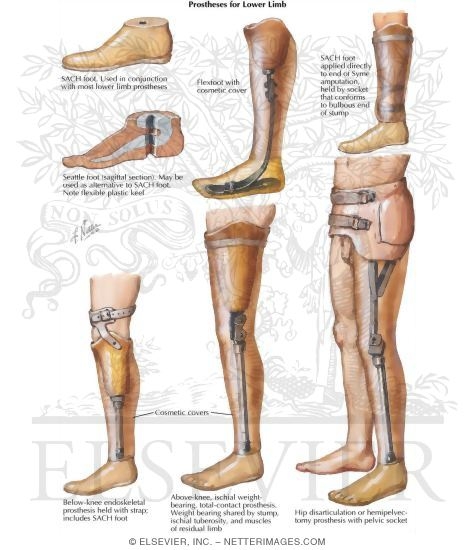 Leg Prosthesis Types