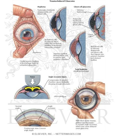 secondary glaucoma