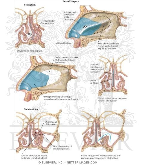 Nasal Surgical Techniques