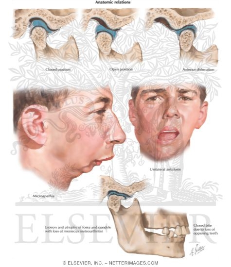 Abnormalities of Temporomandibular Joint