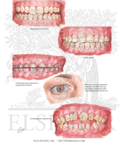 Dental Abnormalities
