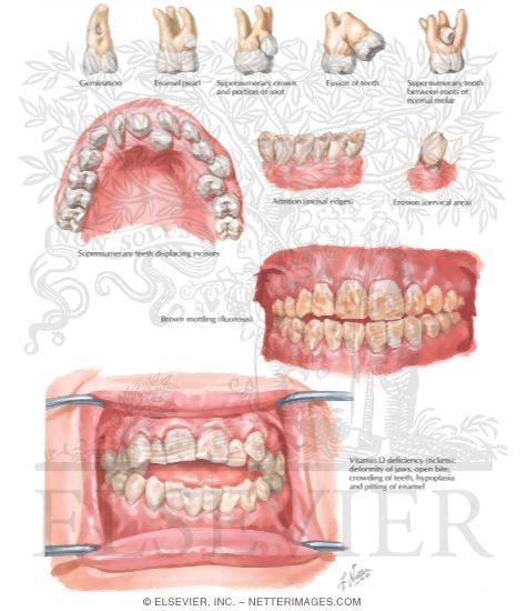 Dental Abnormalities