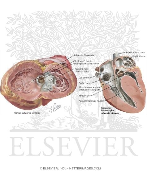 Anomalies of the Left Ventricular Outflow Tract