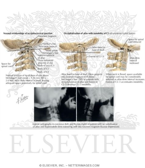 Congenital Anomalies of Occipitocervical Junction