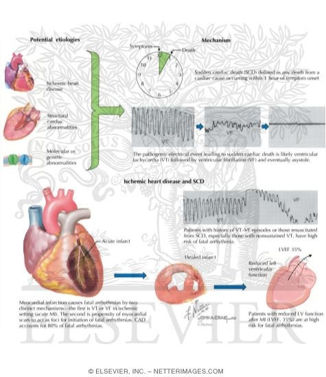 Sudden Cardiac Death