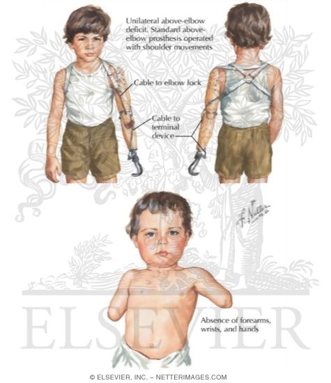 Congenital Limb Deficiency