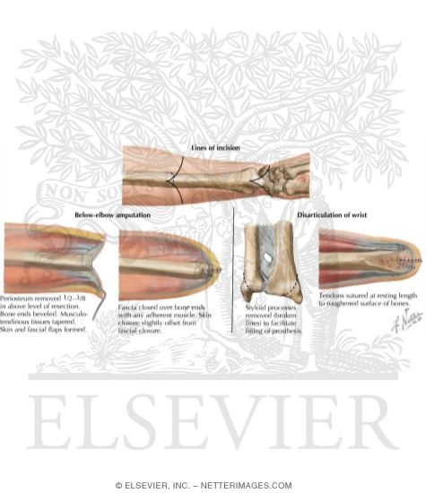 Amputation of the Forearm - Disarticulation Through the Wrist