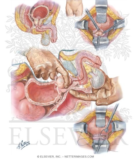 retropubic resection