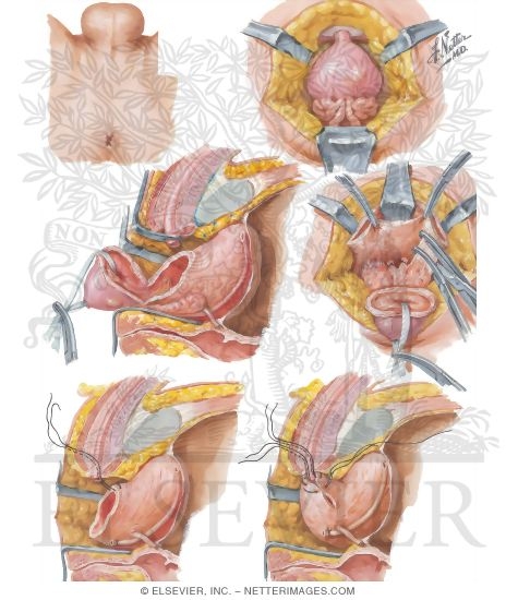suprapubic prostatectomy